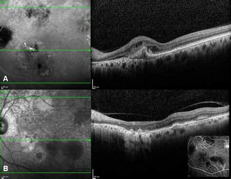 Baseline Images Showing Polyps In Icga A With Corresponding Sd Oct