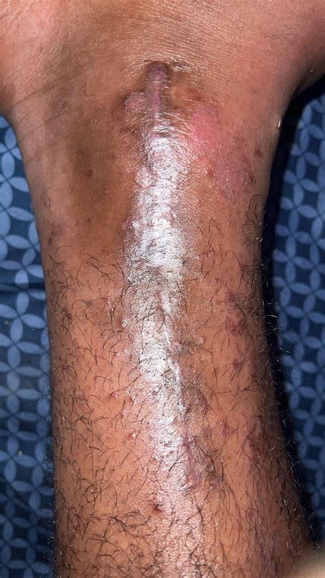 Fractured Tibia And Fibula Rbrokenbones