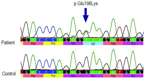 Sanger Sequencing Results For Variant Pglu198lys On The Left Side Is Download Scientific