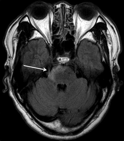 A 63 Year Old Man With Neurosyphilis Involving The Right Trigeminal Download Scientific Diagram