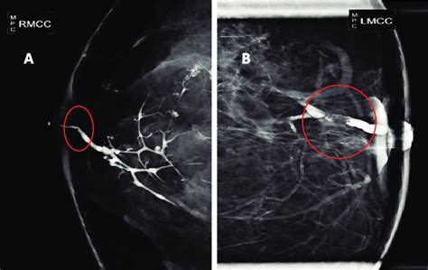 Galactography Suggestive Of Breast Papillary Lesions A Galactography