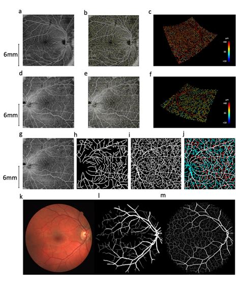 Blood Vessel Segmentation From Oct A Data With Pi Gan A And D Oct A