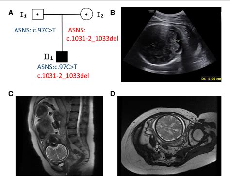 figure 1 from case report a compound heterozygous mutations in asns
