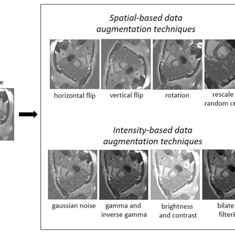 Both Spatial And Intensity Based Data Augmentation Techniques Are