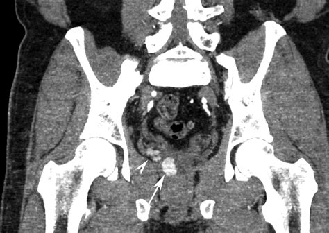 Percutaneous Embolization Of A Postsurgical Prostatic Artery