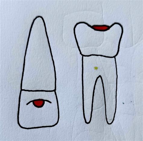 Blacks Classification Of Caries Flashcards Quizlet