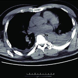 On The 4 Th Day After Injury Chest CT Presented A Fracture Of The Left Download Scientific