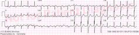 Dr Smith S ECG Blog
