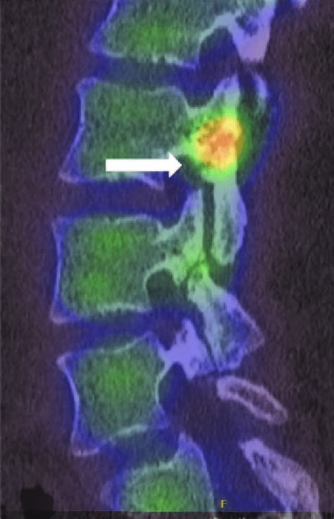 Sagittal Single Photon Emission Ct Reconstruction Showing More Acute L3 Download Scientific
