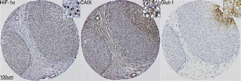 Tissue Microarray Slide Stained For Hypoxia Inducible Factor 1α Download Scientific Diagram