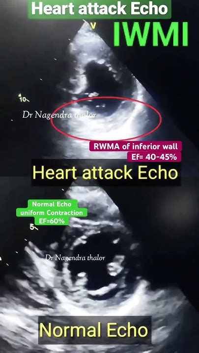 Normal Vs Heart Attack Echo L Rwma In Echo L नार्मल और हार्ट अटैक का