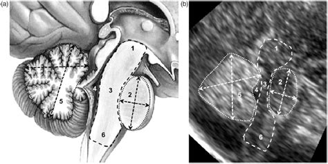 A Illustration Of The Midsagittal Midbrain Hindbrain Showing The Download Scientific Diagram