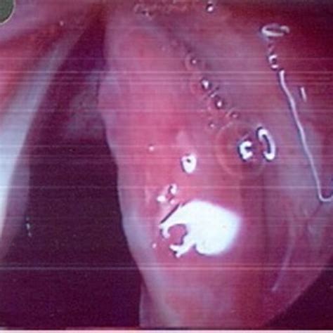 Case 1—diffuse Erythema And Thickening Of Right True Cord Download