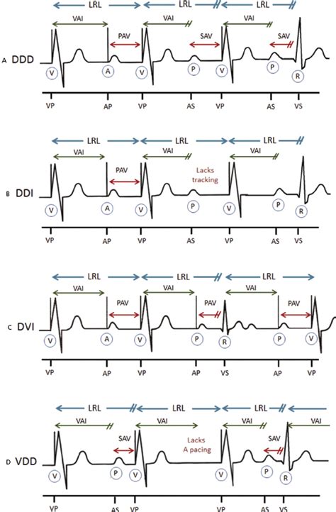 6 Pacemaker Timing Cycles And Special Features Thoracic Key