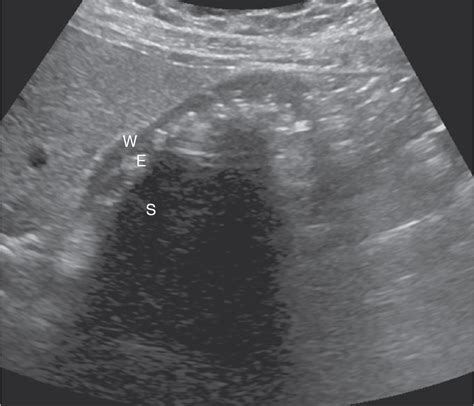 Imaging Features Of Gallbladder And Biliary Tract Disease Clinical Tree