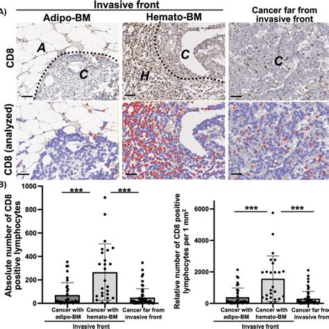 Invasive Front With Adipocyte‐rich Bone Marrow Adipo‐bm And