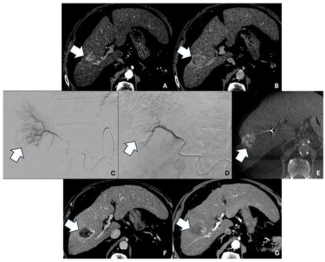 Transarterial Chemoembolization With Biopearls For The Treatment Of Hepatocellular Carcinoma A