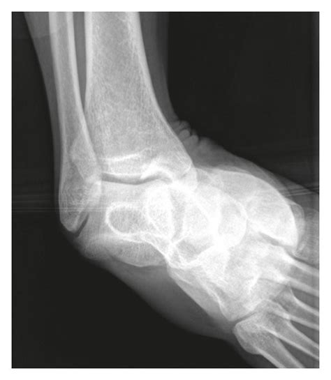 Ap A And Lateral B Ankle X Rays Demonstrating A Medial Subtalar Download Scientific Diagram