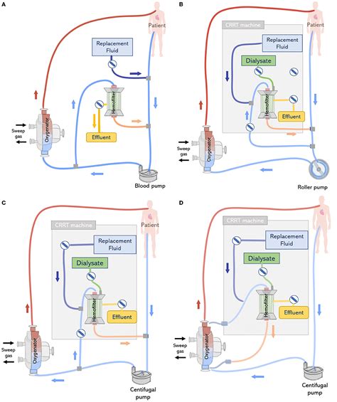 Combining Ecmo And Crrt Physiology For Perfusionist Facebook