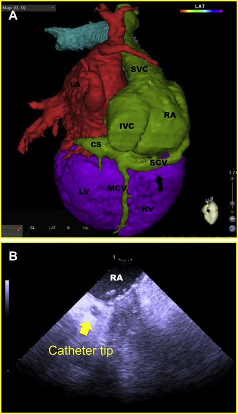 Cavotricuspid Isthmus Ablation For Atrial Flutter Anatomic Challenges And Troubleshooting Pmc