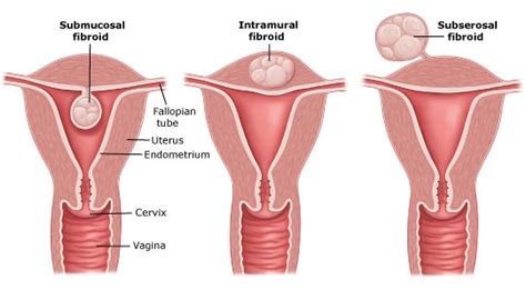Fibroids And Infertility Is There A Relationship