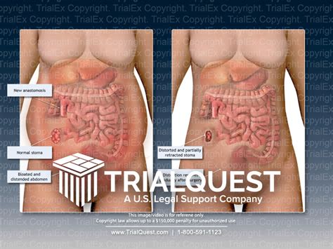 Loop Ileostomy Distortion Trial Exhibits Inc