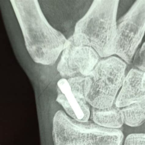 9th Month Follow Up Showing Continuity Of Trabecular Pattern