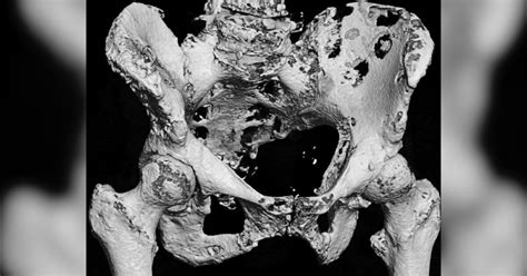 Metastasis En Los Huesos