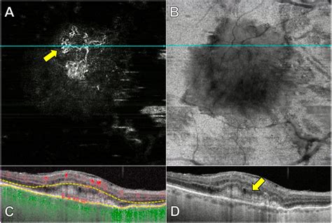 Choroidal Neovascularization Oct