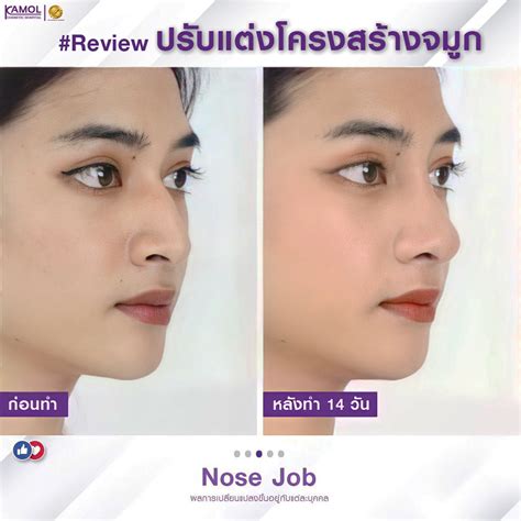 รีวิวปรับโครงสร้างก โรงพยาบาลกมล ศัลยกรรมตกแต่งและแปลงเพศ