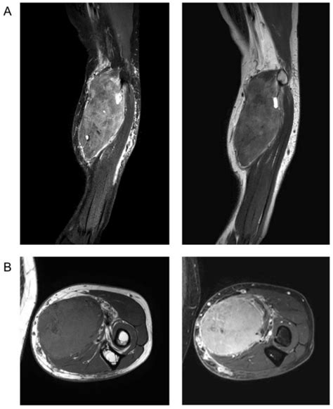Musculoskeletal Soft Tissue Sarcoma Quality Assessment Of Initial Mri