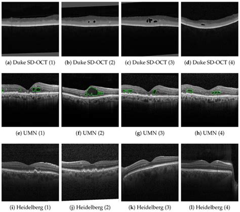 Retinal Layers Oct