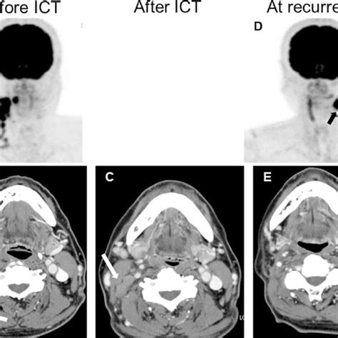 T2n3 Uicc 7th Edition Squamous Cell Carcinoma Of The Right Tonsil