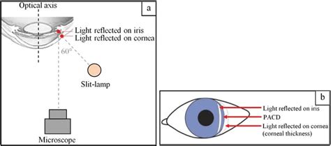 Nghiệm Pháp Van Herick Trong Khám Và điều Trị Bệnh Về Mắt