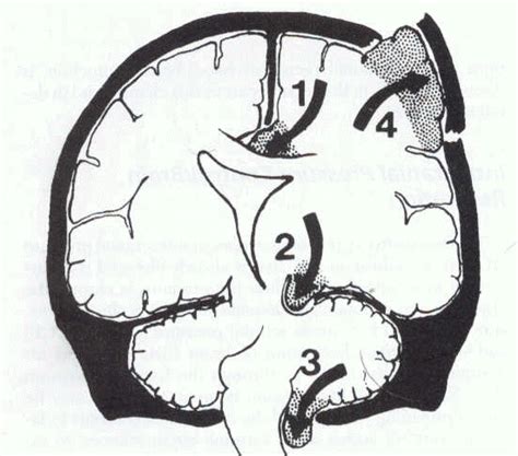 Doctors Gates Brain Herniation Sites