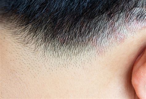 Ringworm Of The Scalp Causes Symptoms Treatment More
