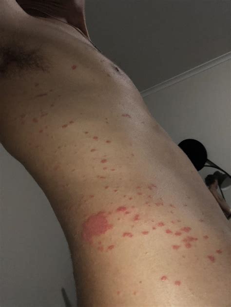 Are These Bed Bug Bites Someone Please Help R Bugbites