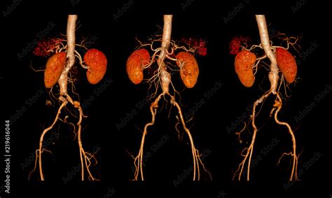 Cta Abdominal Aorta And Femoral Run Off Findings Infrarenal Aortic Aneurysm With Partial