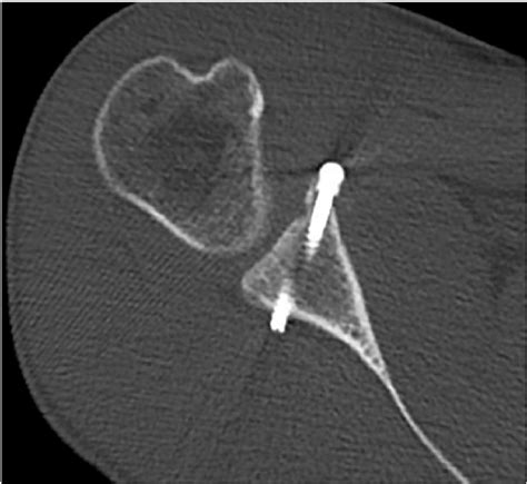 Axial Ct Scan At The Widest Point Of The Glenoid After Arthroscopic