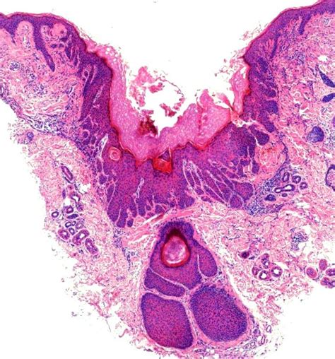 Pathology Of Dilated Pore Of Winer Pathology Medical Laboratory Derm