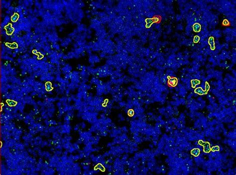 Ai Driven Precision Pathology Meets Spatial Biology