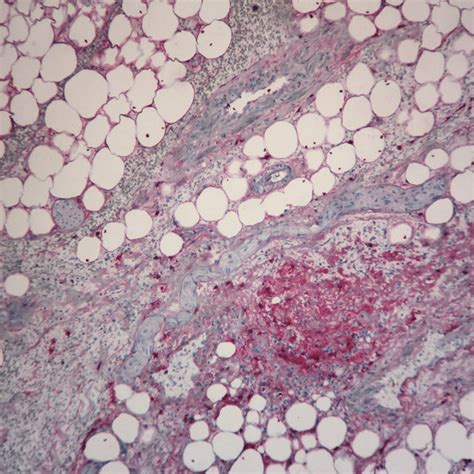 Detection Of Fibronectin By Immunohistochemical Staining × 100 Download Scientific Diagram