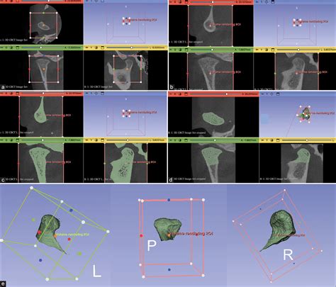 Three Dimensional Assessment Of Condylar Morphology Position And