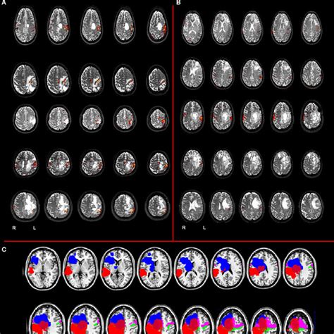 A Activation Maps For Whole Brain Glm Analysis Related To Verb Download Scientific Diagram