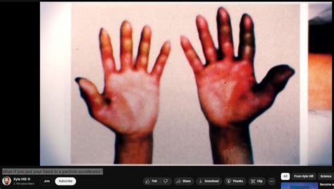 Hanoi Incident What If You Put Your Hand In A Particle Accelerator