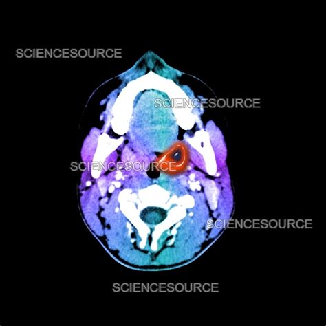 Color Enhanced Ct Of Tonsillar Abscess Stock Image Science Source Images