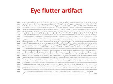 Eeg Artifacts