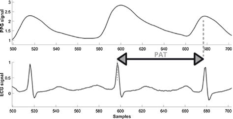Pulse Arrival Time Estimation Based On The Ppg And Ecg Wave Forms