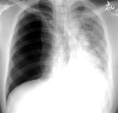 4 ﻿interpret This Cxr And Explain Reasoning Behind