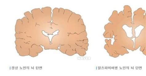 알츠하이머 초기 증상시간·날짜 구분 못하고 심하면 길 잃기도